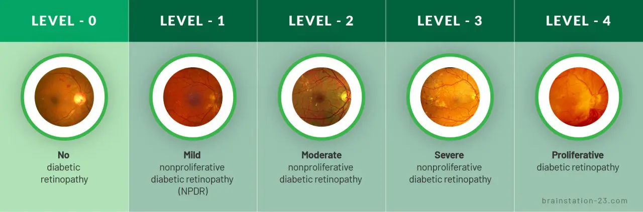 Diabetic Retinopathy | Brain Station 23 | Talent @ Your Service Diabetic Retinopathy | Brain Station 23 | Talent @ Your Service